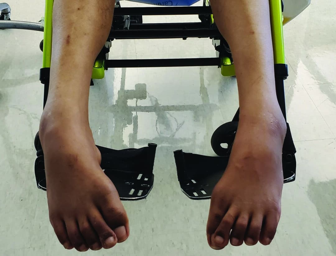 Serial Casting for Spasticity - Rehab Management