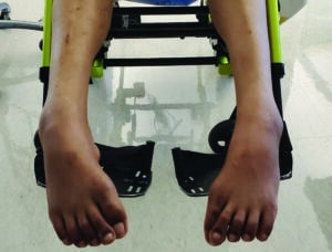 Serial Casting for Spasticity - Rehab Management